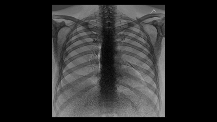 Dual Energy Subtraction | GE Healthcare