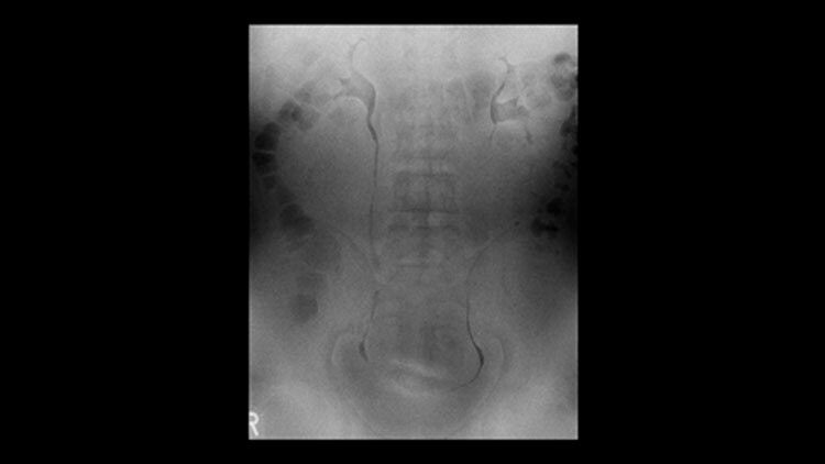 Dual Energy Subtraction | GE Healthcare
