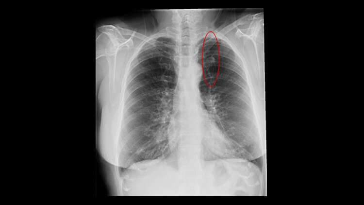 Dual Energy Subtraction | GE Healthcare