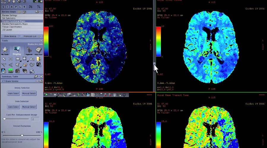 CT Perfusion 4D Multi-organs | GE Healthcare