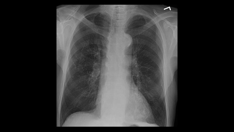 Dual Energy Subtraction | GE Healthcare