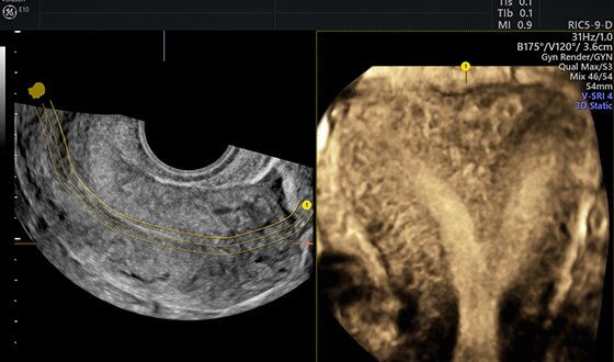 Voluson E6 | GE Healthcare