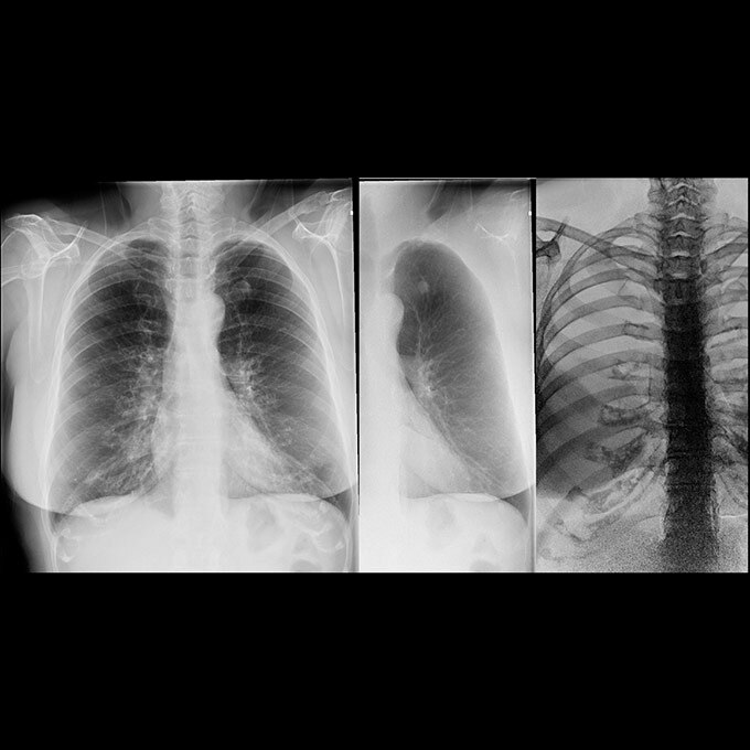 Dual Energy Subtraction | GE Healthcare (Korea)