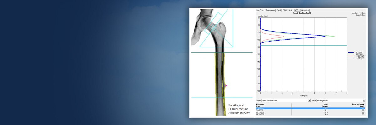 INCIPIENT ATYPICAL FEMUR FRACTURES | GE Healthcare