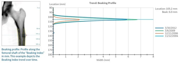 INCIPIENT ATYPICAL FEMUR FRACTURES | GE Healthcare