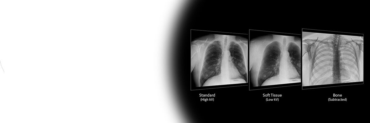 Dual Energy Subtraction | GE Healthcare (Korea)