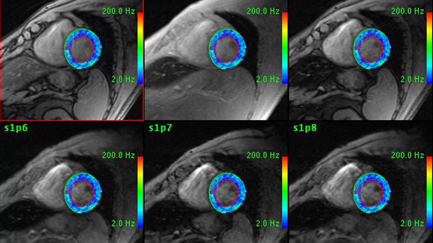 Cardiology Advanced Visualization | GE HealthCare (Korea)