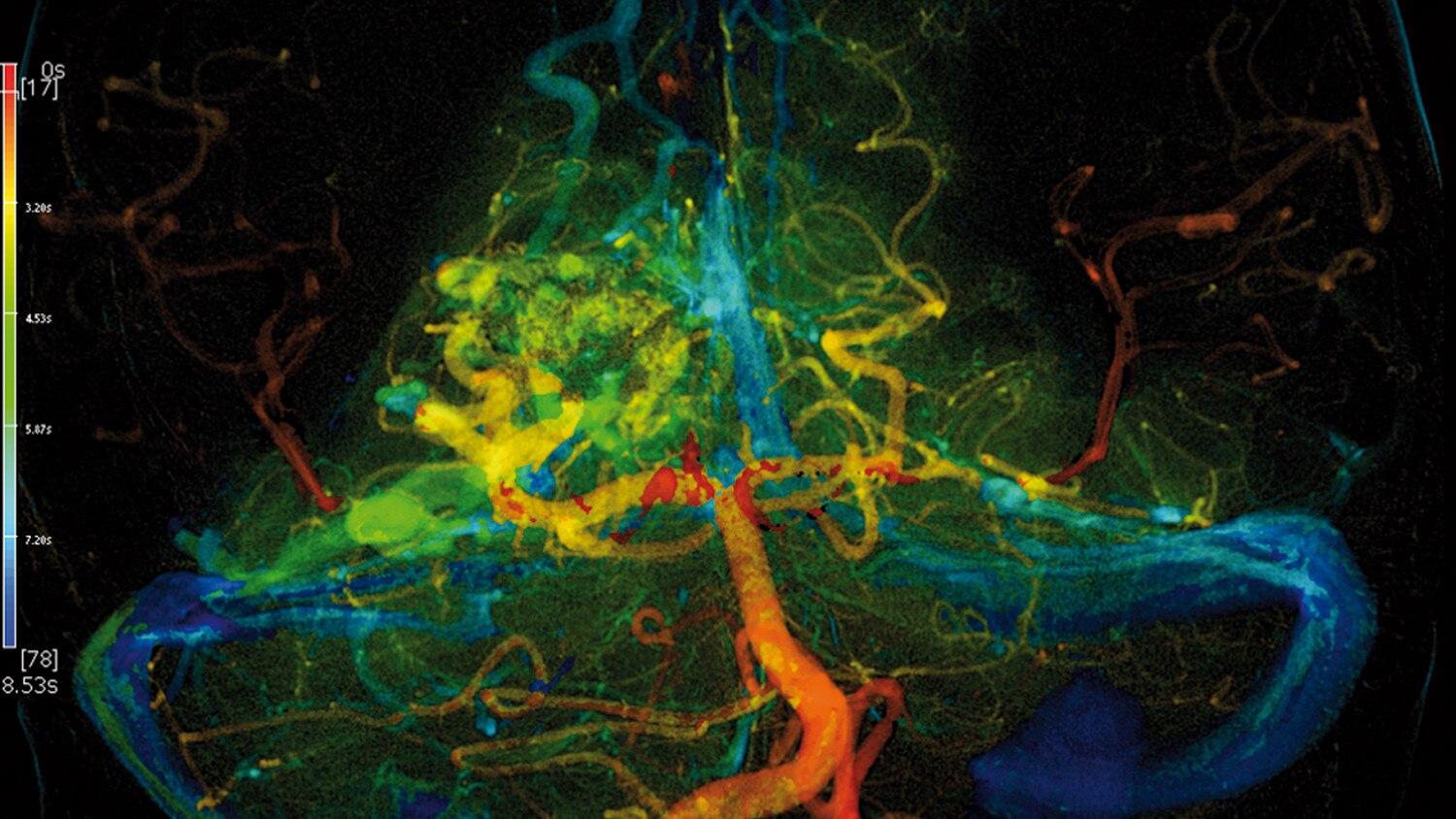 Vascular Advanced Visualization | GE HealthCare (Korea)